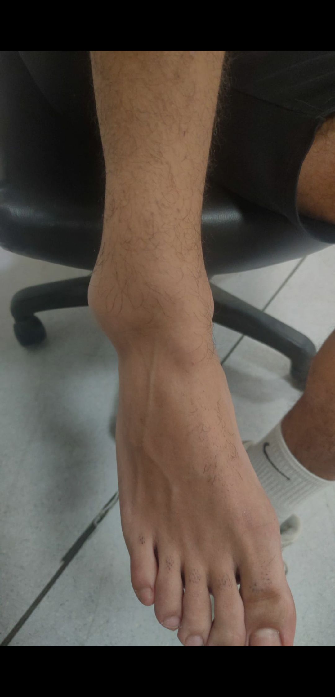 Halı saha maçında sakatlandım ayagımın durumu (SS) Ayağımın son hali ...